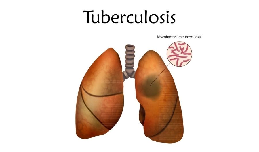 Tuberculosis: El desafío de controlar una epidemia que sigue amenazando ...